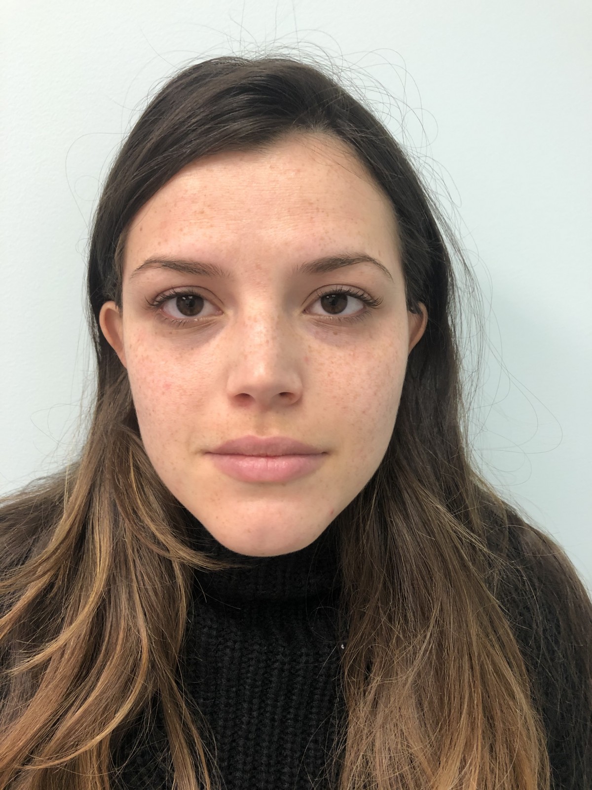 What is PRF and what can it treat? - Raleigh Plastic Surgery Center